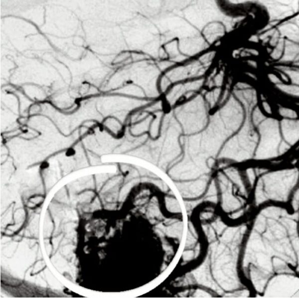 Malformación Arteriovenosa (MAV): Causas y tratamiento