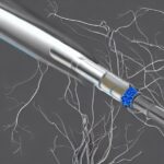 Malformación Arteriovenosa (MAV): Causas y tratamiento